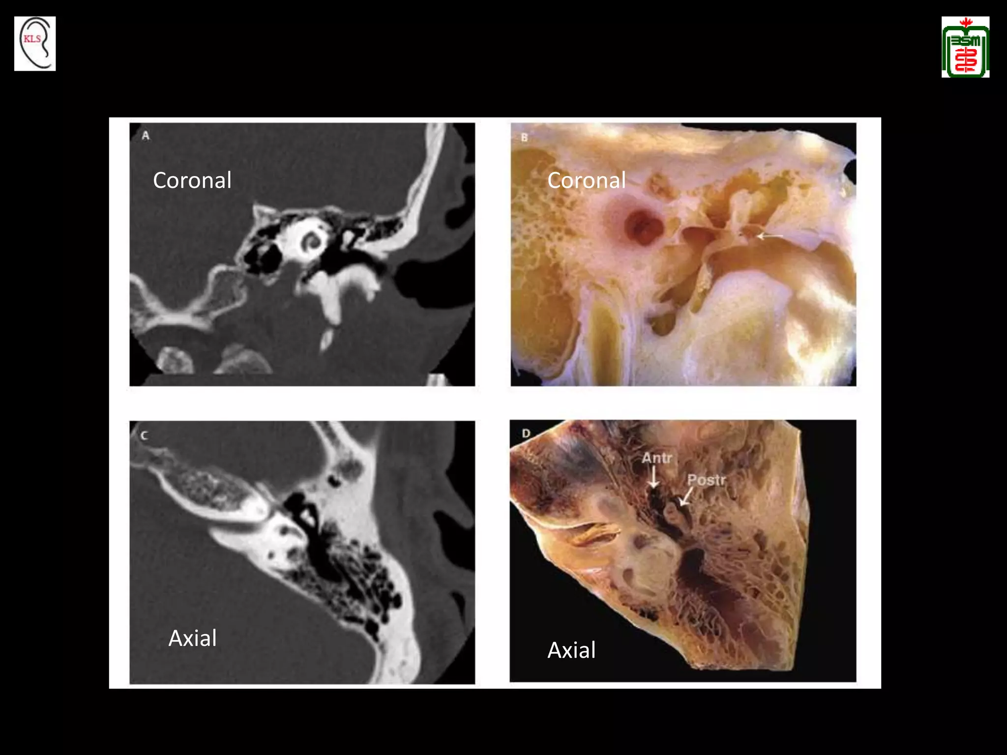 Imaging of the temporal bone | PPTX