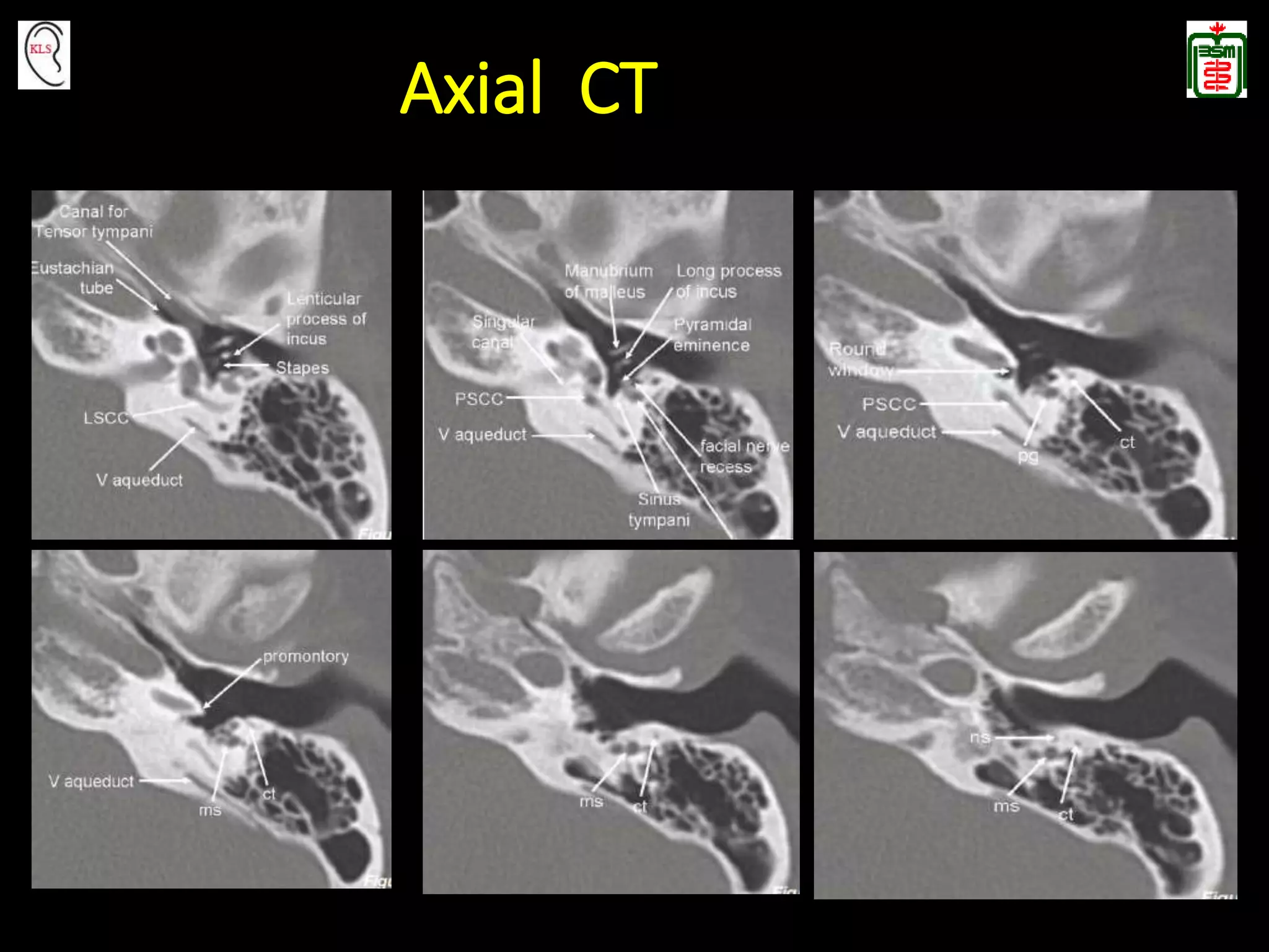 Imaging of the temporal bone | PPTX