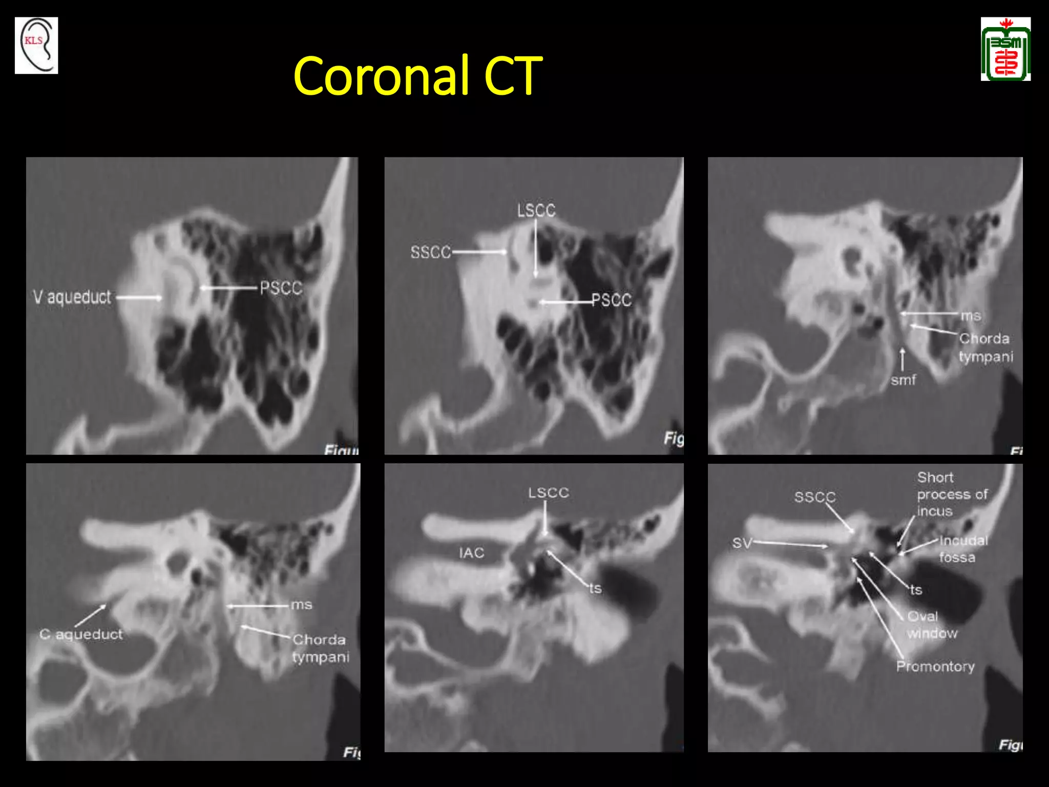 Imaging of the temporal bone | PPTX