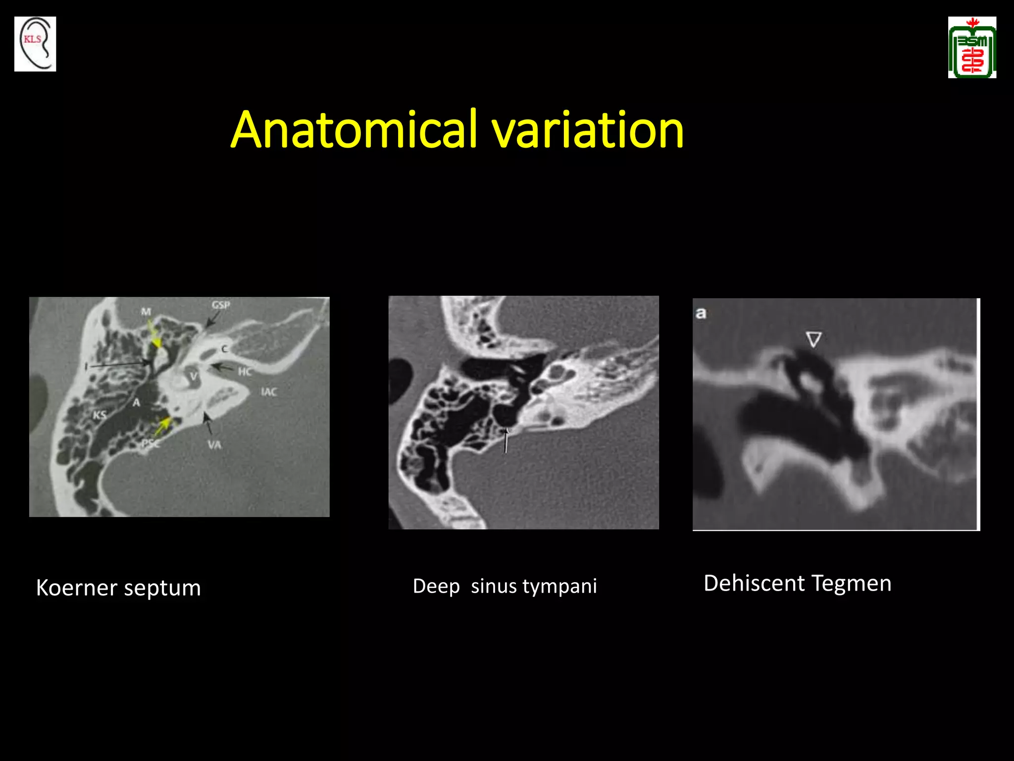 Imaging of the temporal bone | PPTX