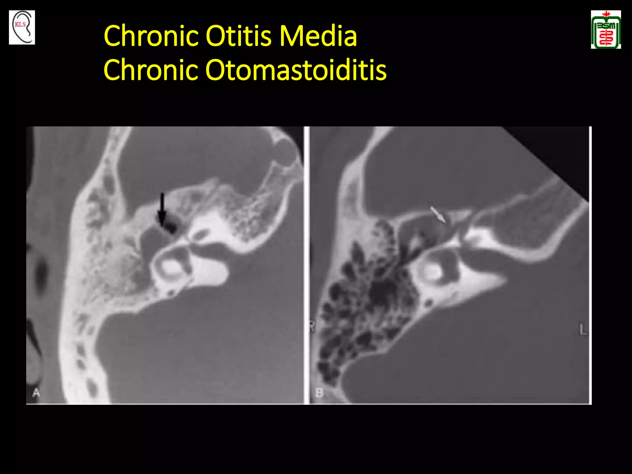 Imaging of the temporal bone | PPTX