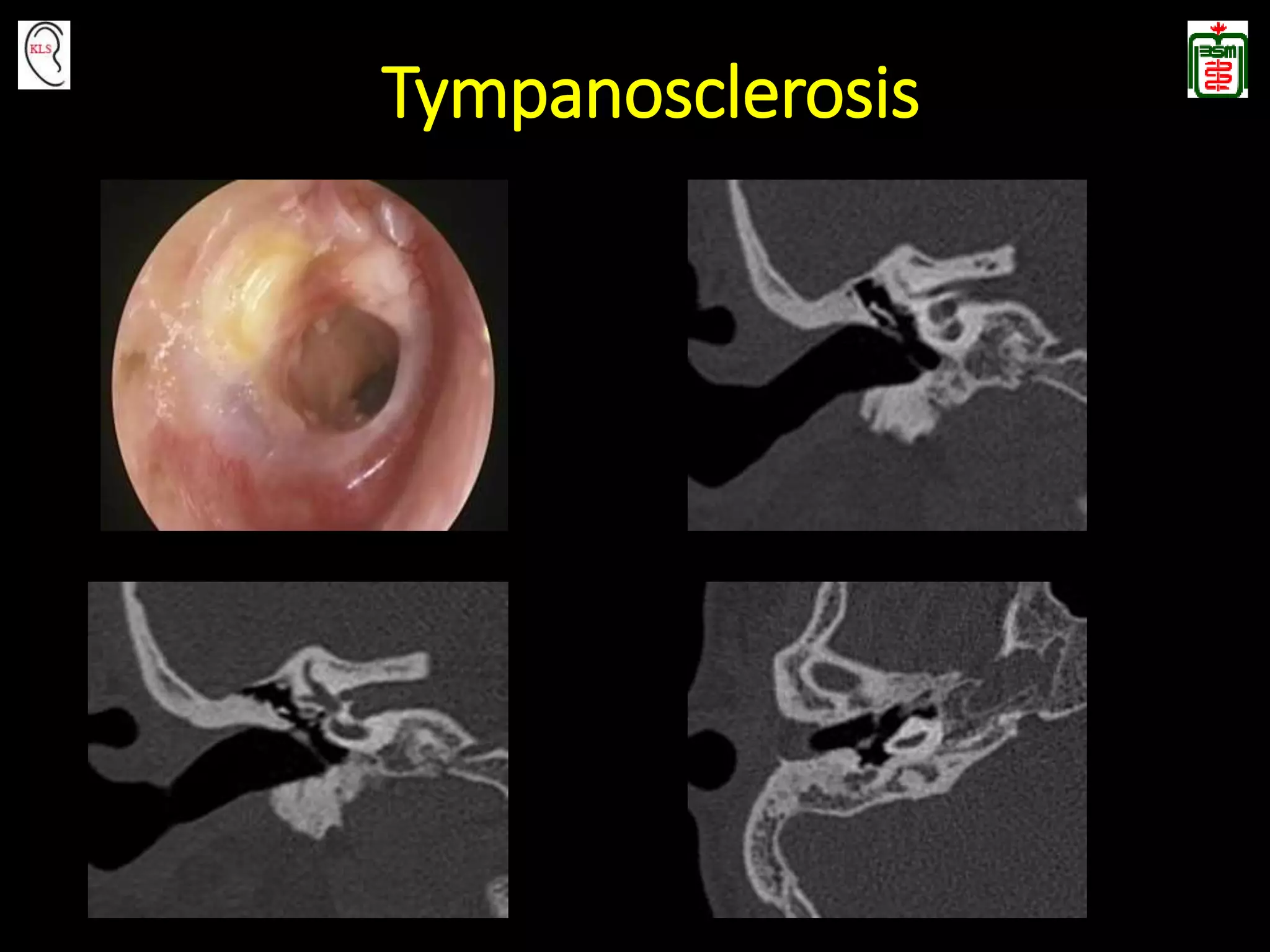 Imaging of the temporal bone | PPTX