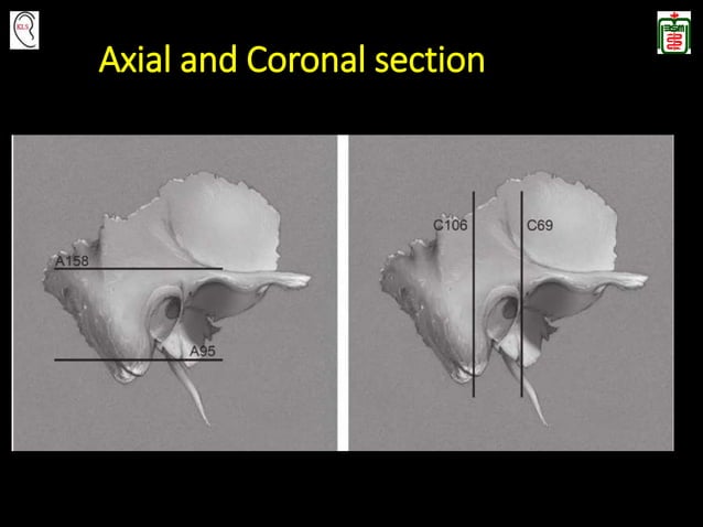 Imaging of the temporal bone | PPTX | Ear, Nose and Throat Conditions ...