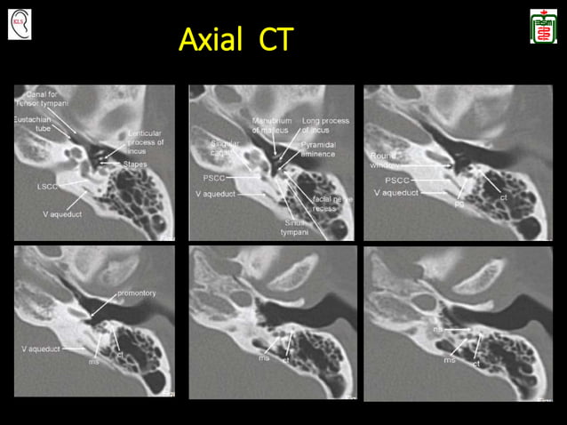 Imaging of the temporal bone | PPTX | Ear, Nose and Throat Conditions ...