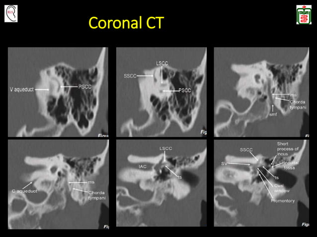 Imaging of the temporal bone | PPTX | Ear, Nose and Throat Conditions ...