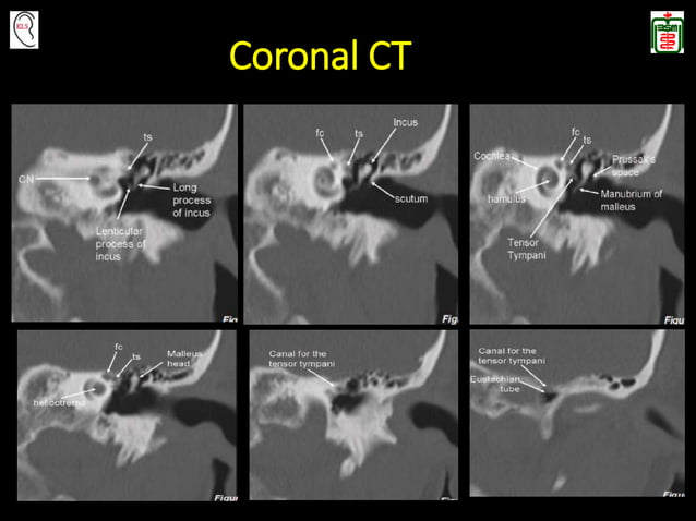 Imaging of the temporal bone | PPTX | Ear, Nose and Throat Conditions ...