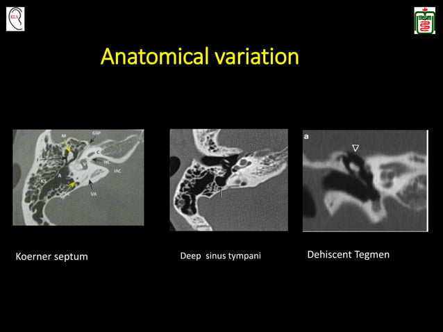 Imaging of the temporal bone | PPTX | Ear, Nose and Throat Conditions ...
