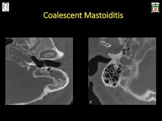 Imaging of the temporal bone | PPTX