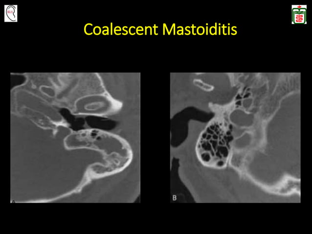 Imaging of the temporal bone | PPTX | Ear, Nose and Throat Conditions ...