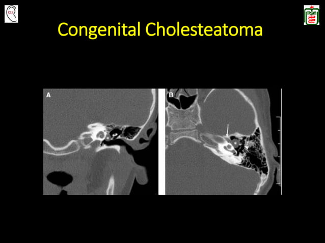 Imaging of the temporal bone | PPTX | Ear, Nose and Throat Conditions ...
