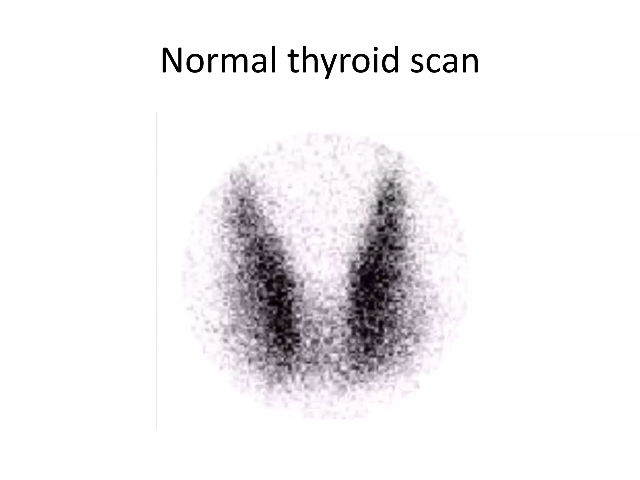 Imaging of the thyroid | PPTX