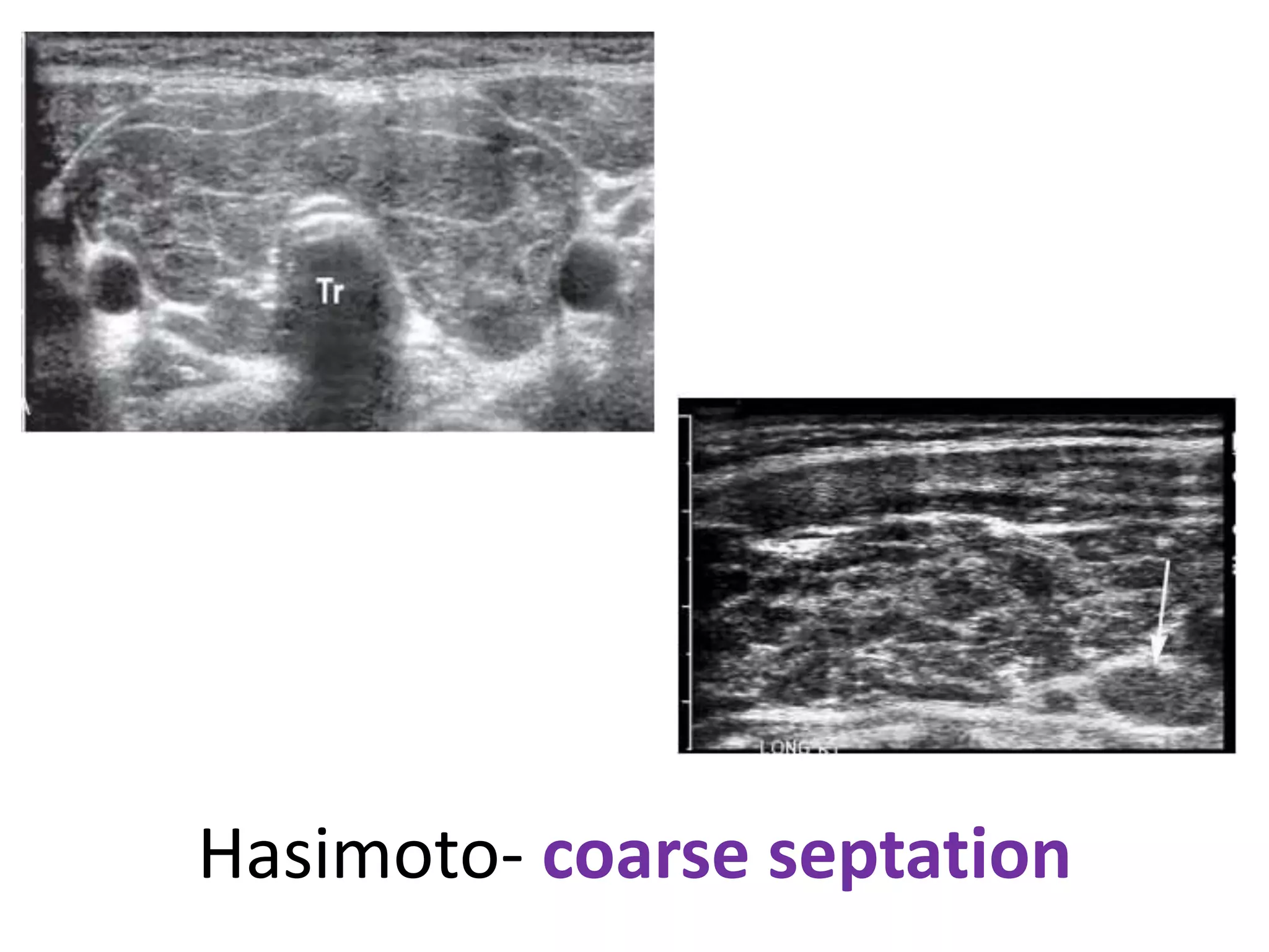 Imaging of the thyroid | PPTX