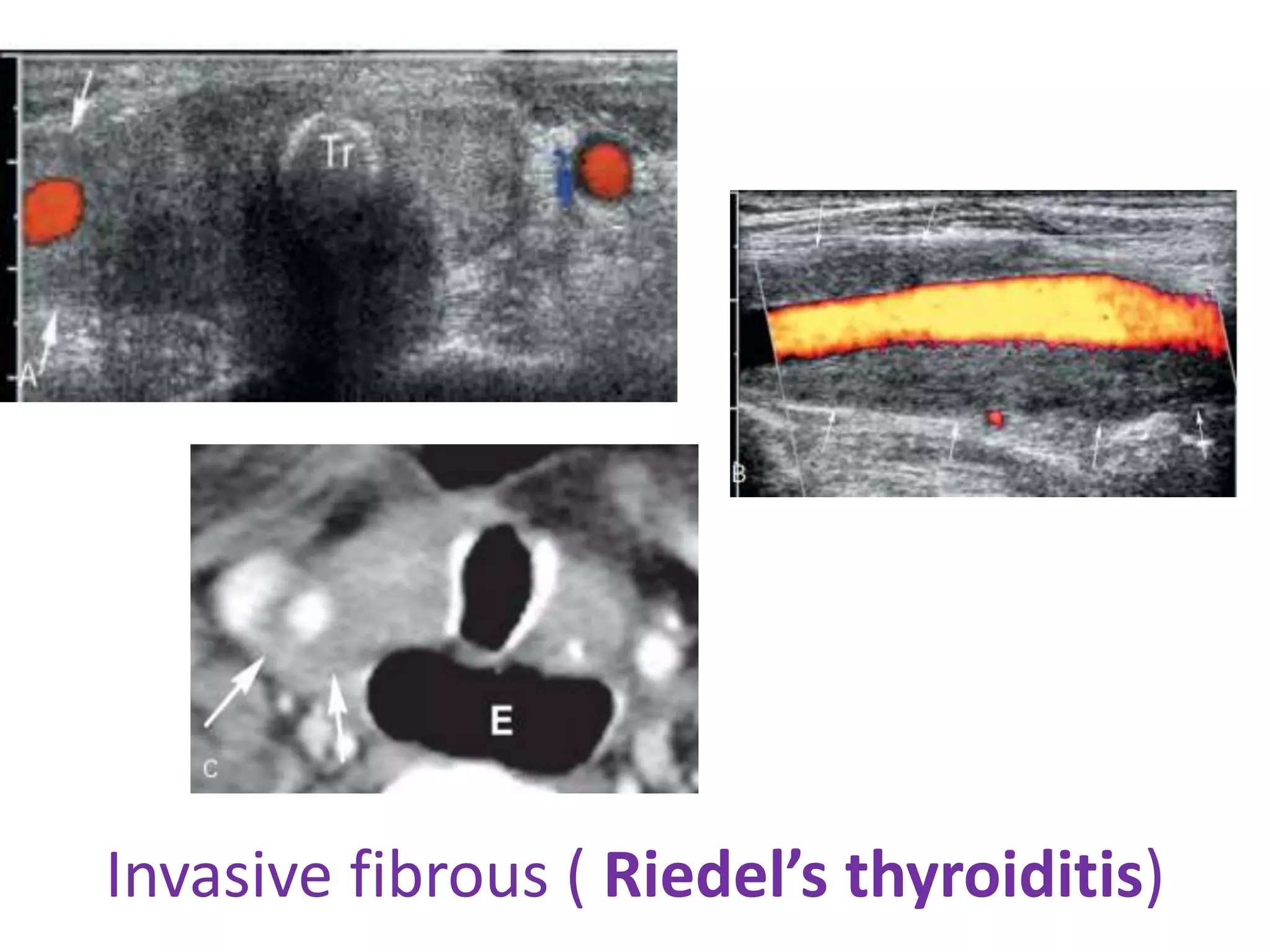 Imaging of the thyroid | PPTX