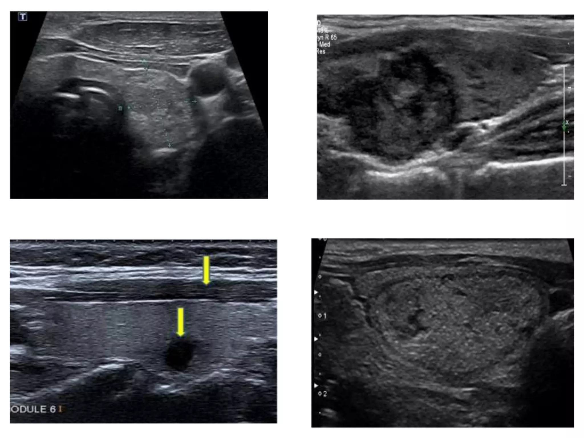 Imaging of the thyroid | PPTX