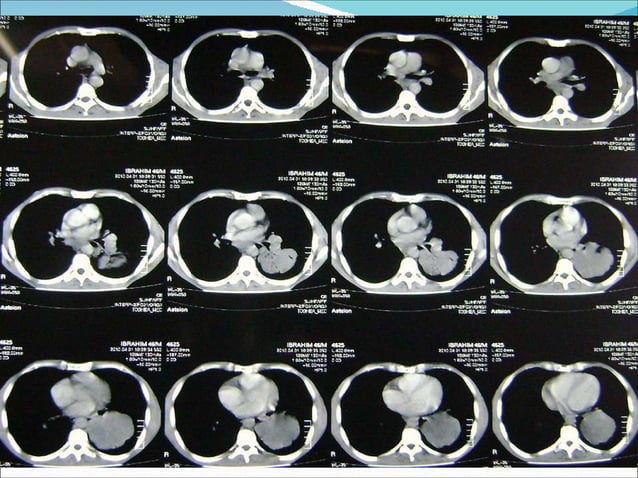 Imaging: Bronchogenic Cyst | PPT | Lung and Respiratory Health ...