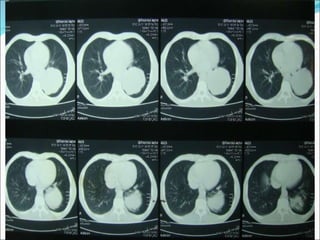 Imaging: Bronchogenic Cyst | PPT