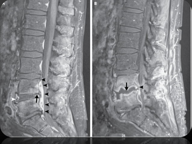 MRI: Collapsed Vertebral Bodies | PPT | Bone and Joint Conditions ...