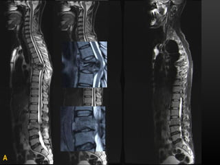 MRI: Collapsed Vertebral Bodies | PPT