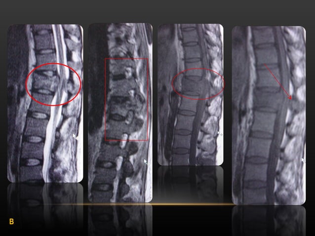 MRI: Collapsed Vertebral Bodies | PPT | Bone and Joint Conditions ...