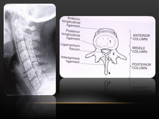 MRI: Collapsed Vertebral Bodies | PPT