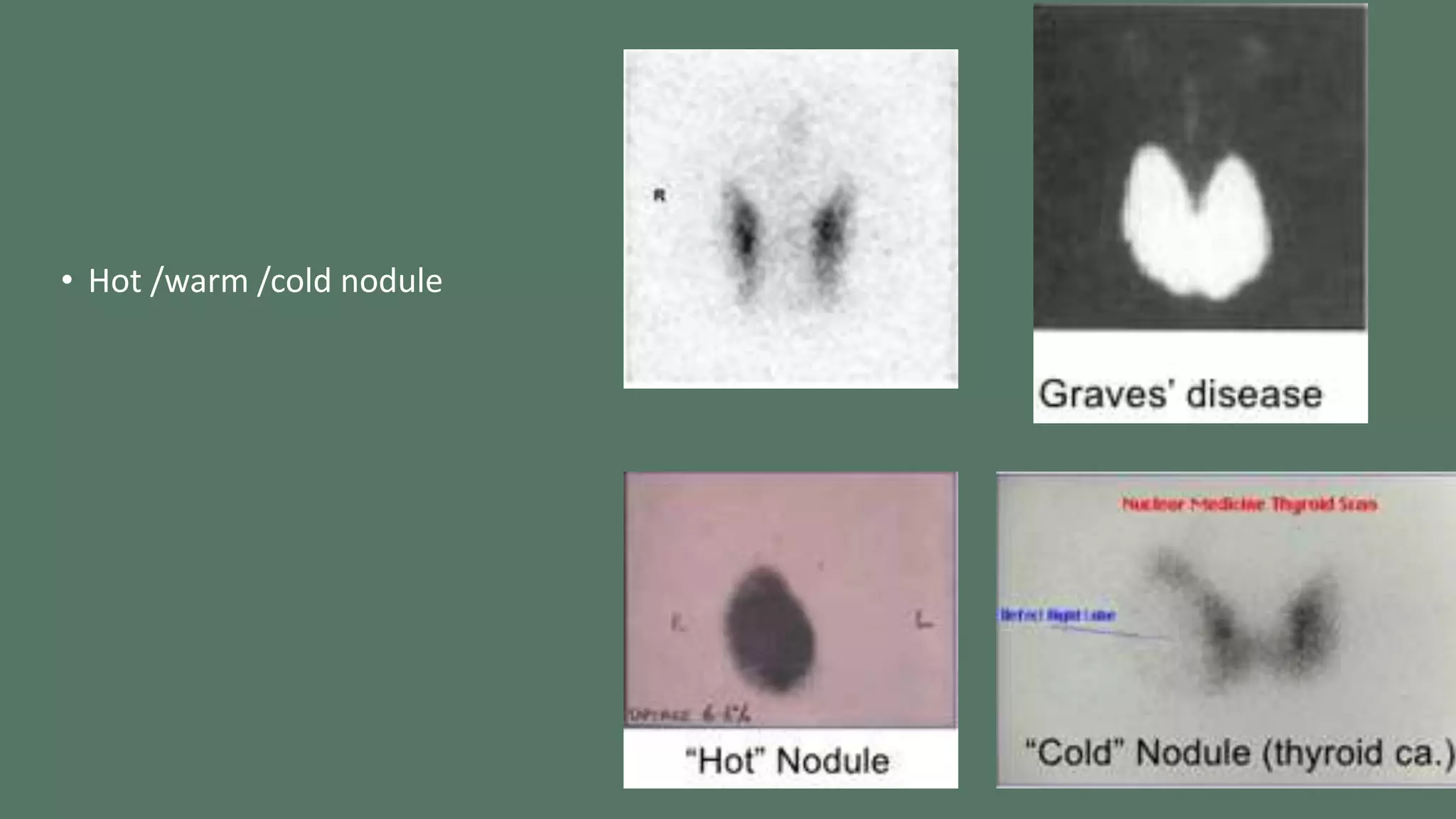 Imaging of thyroid | PPTX