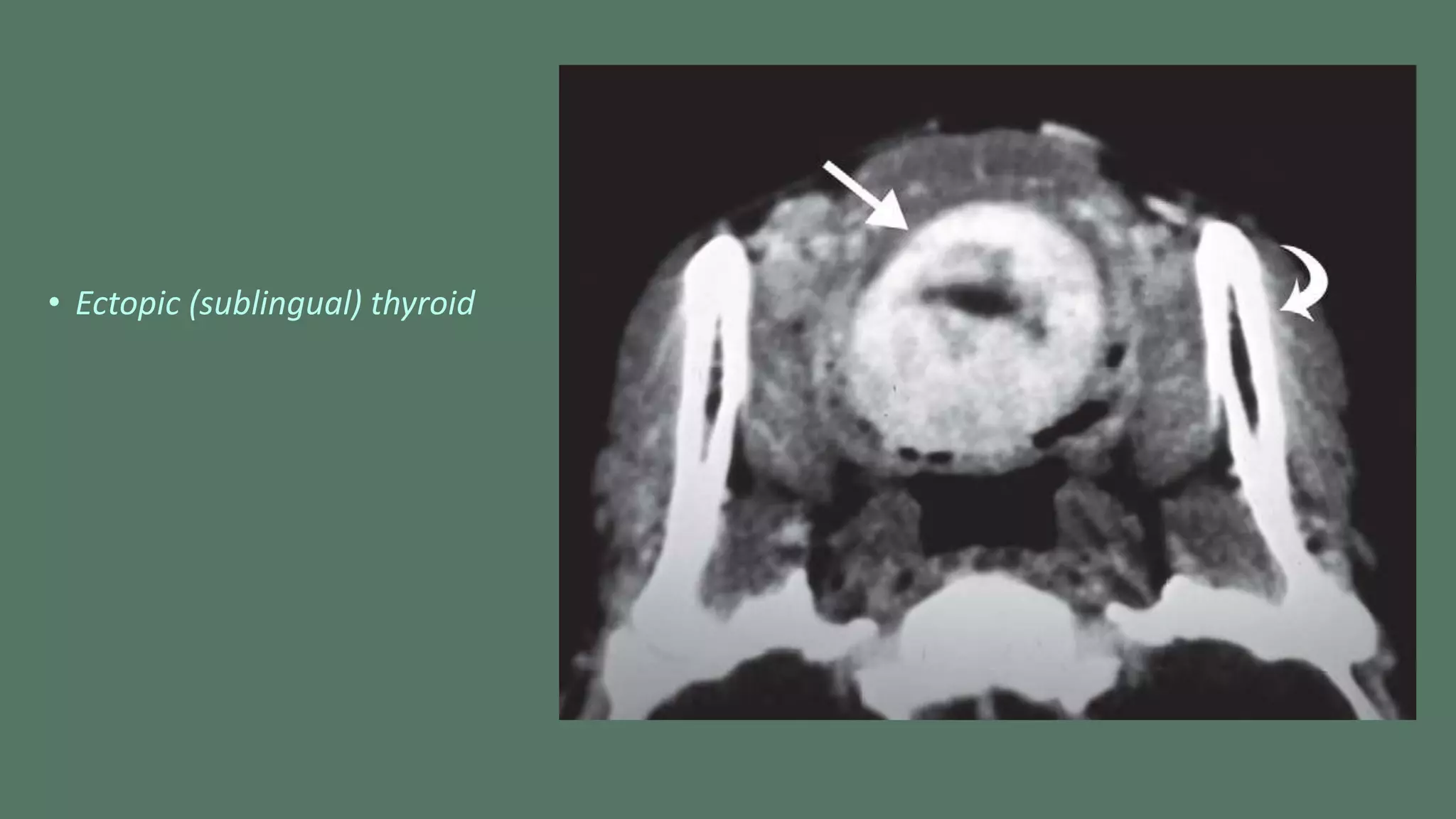 Imaging of thyroid | PPTX