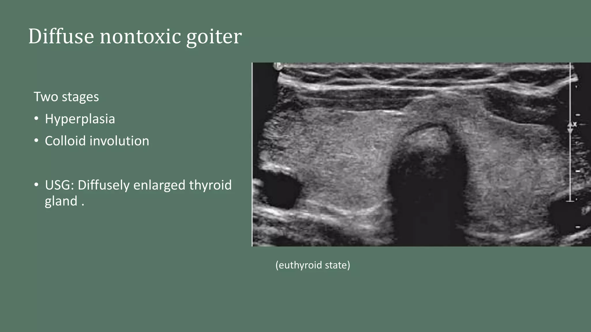 Imaging of thyroid | PPTX