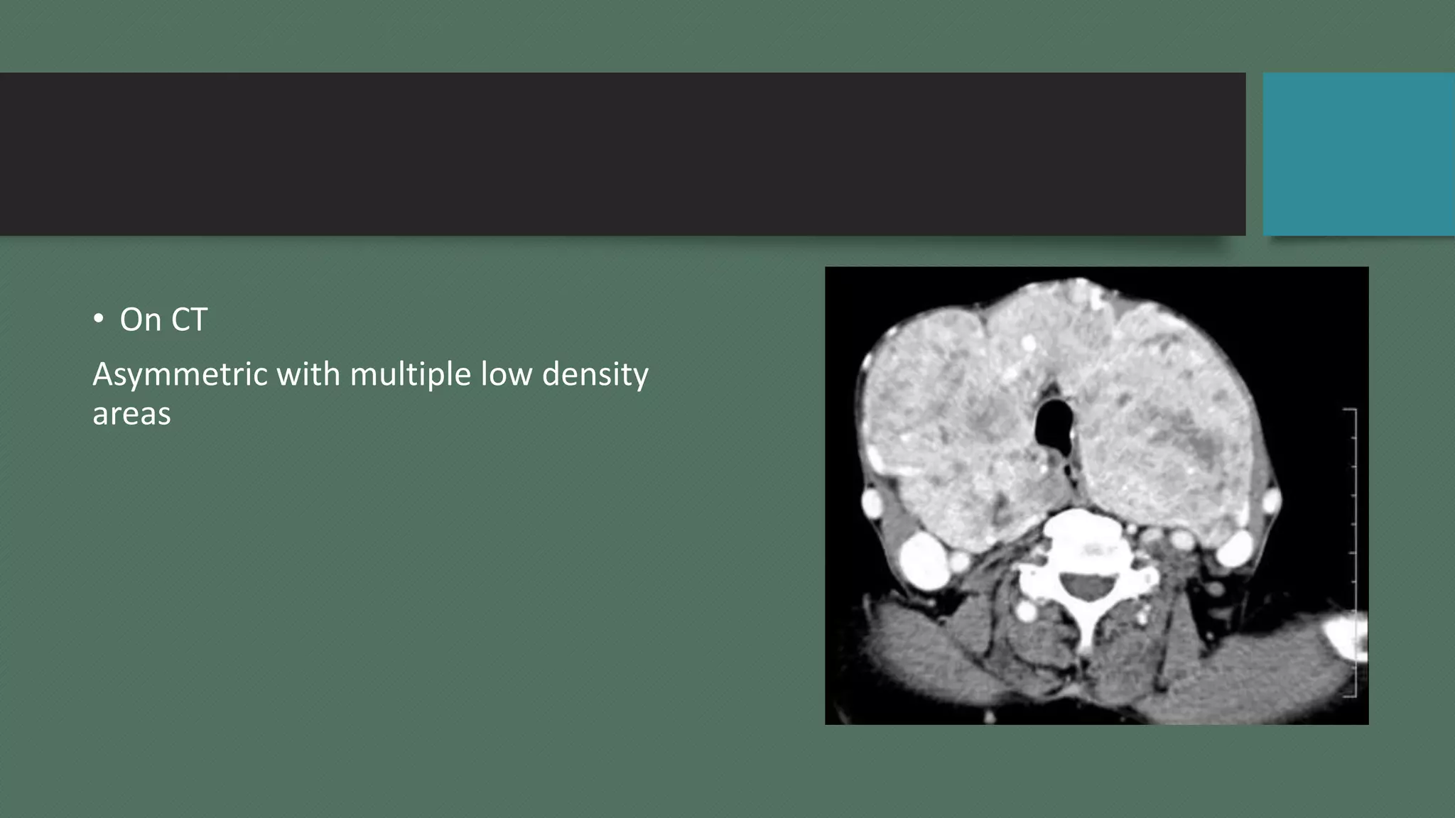 Imaging of thyroid | PPTX