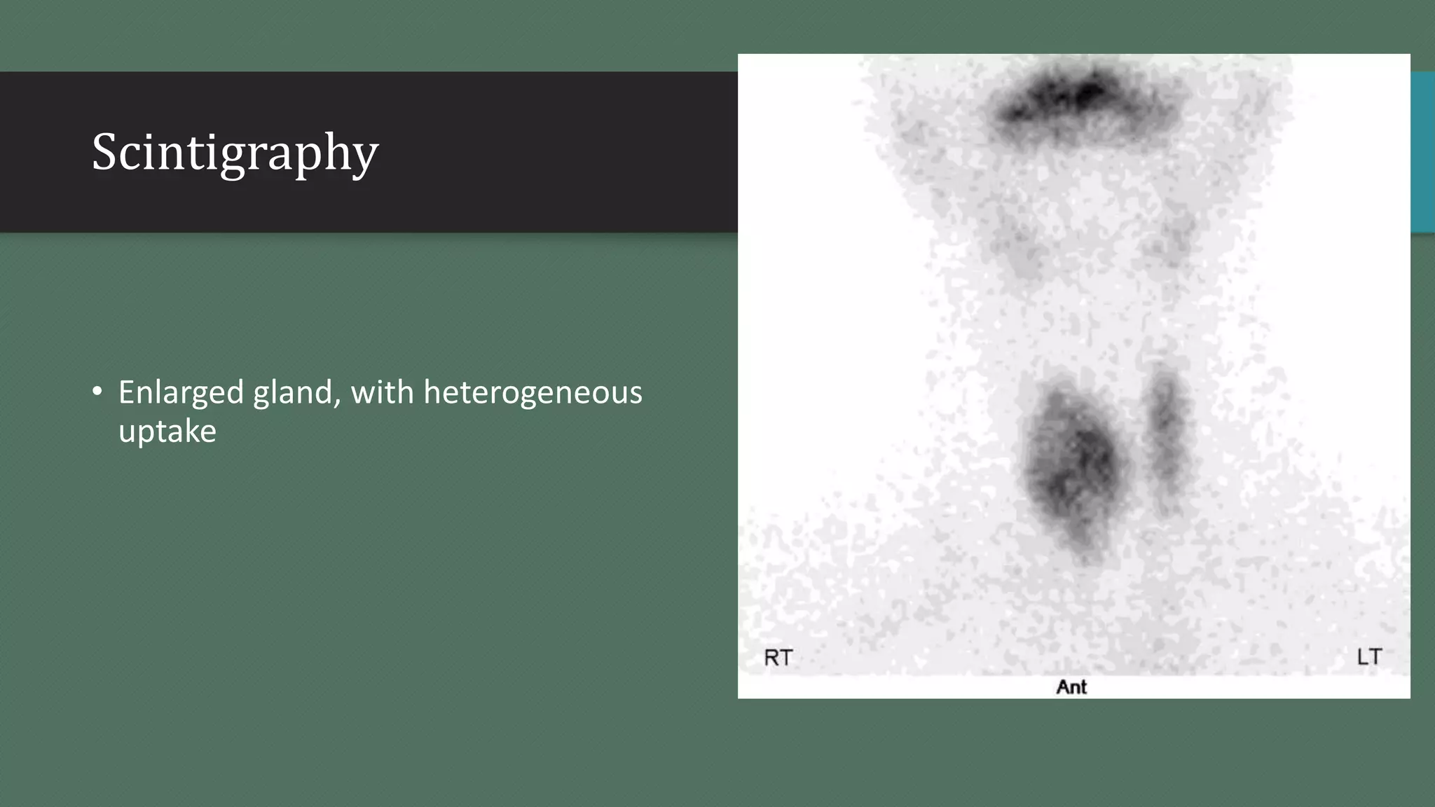 Imaging of thyroid | PPTX