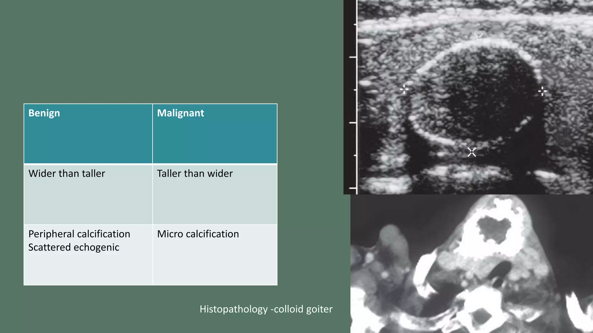 Imaging of thyroid | PPTX