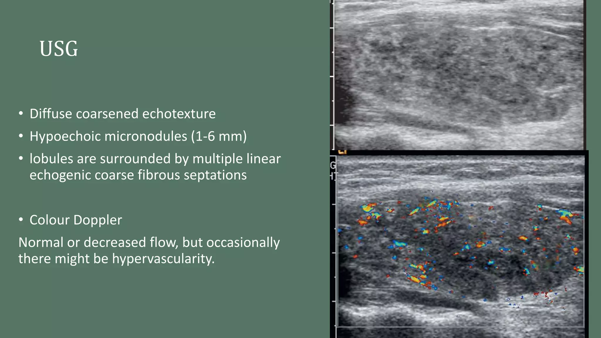 Imaging of thyroid | PPTX
