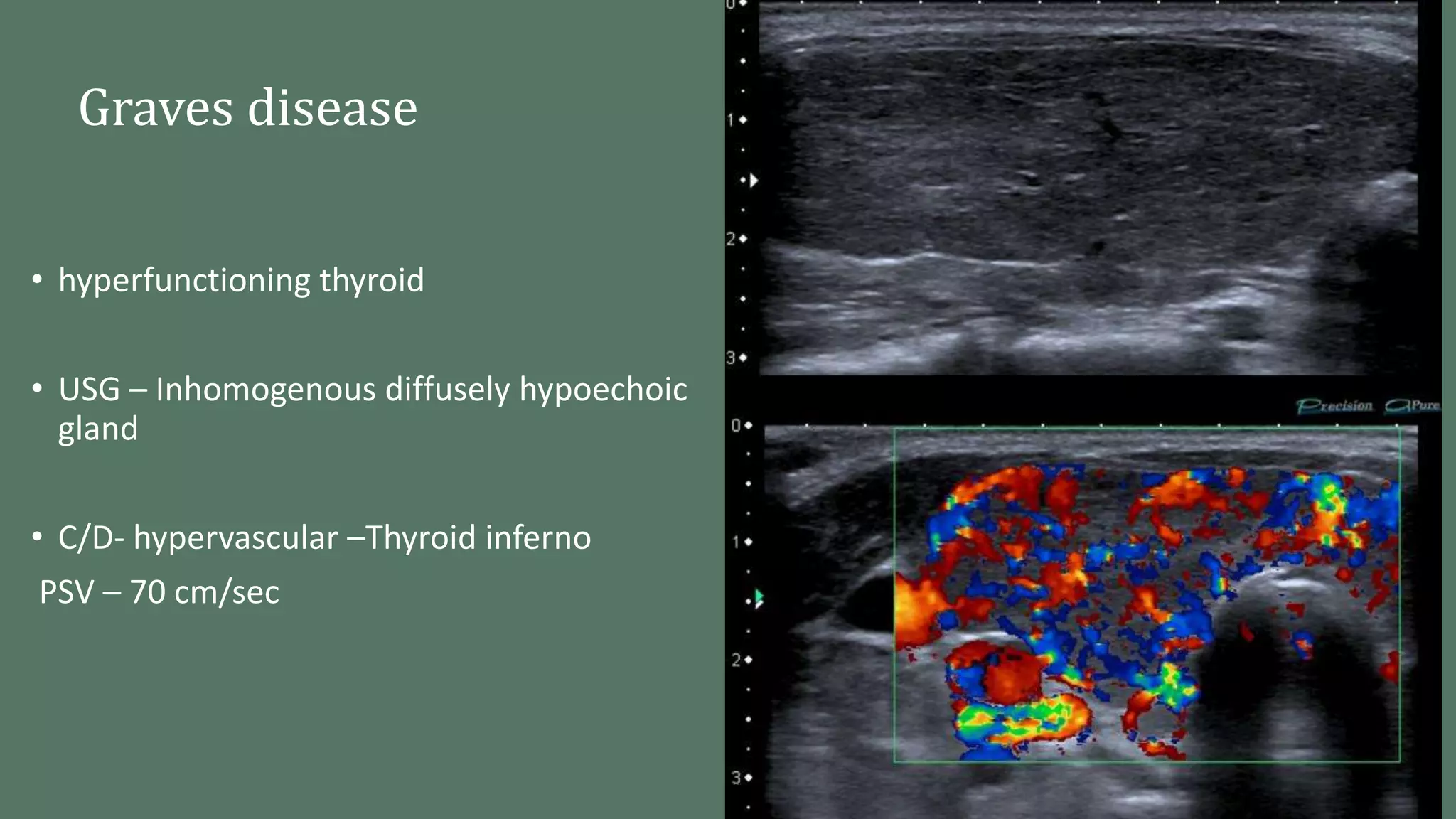 Imaging of thyroid | PPTX