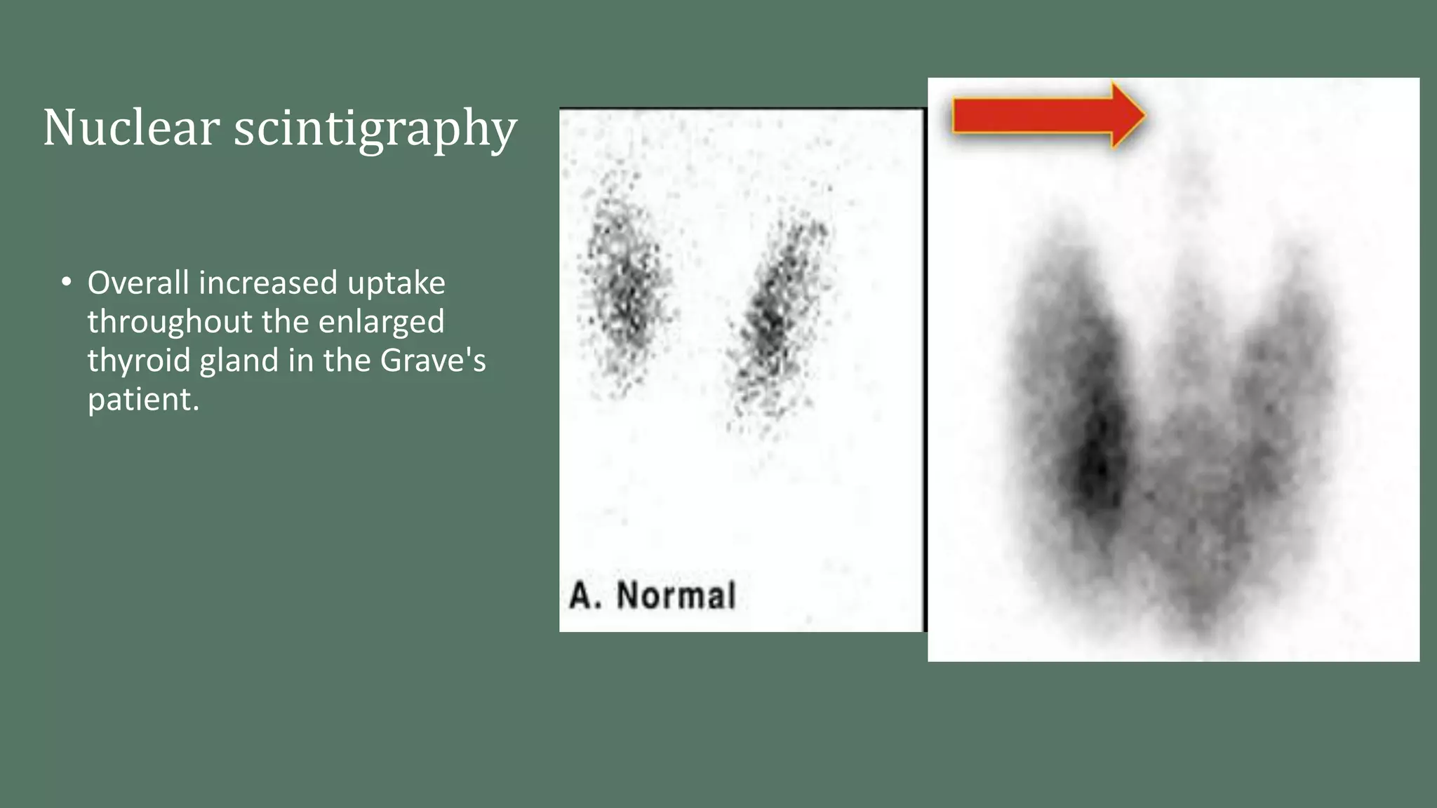 Imaging of thyroid | PPTX