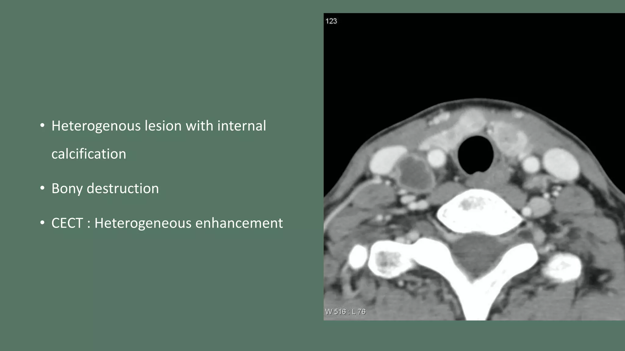 Imaging of thyroid | PPTX