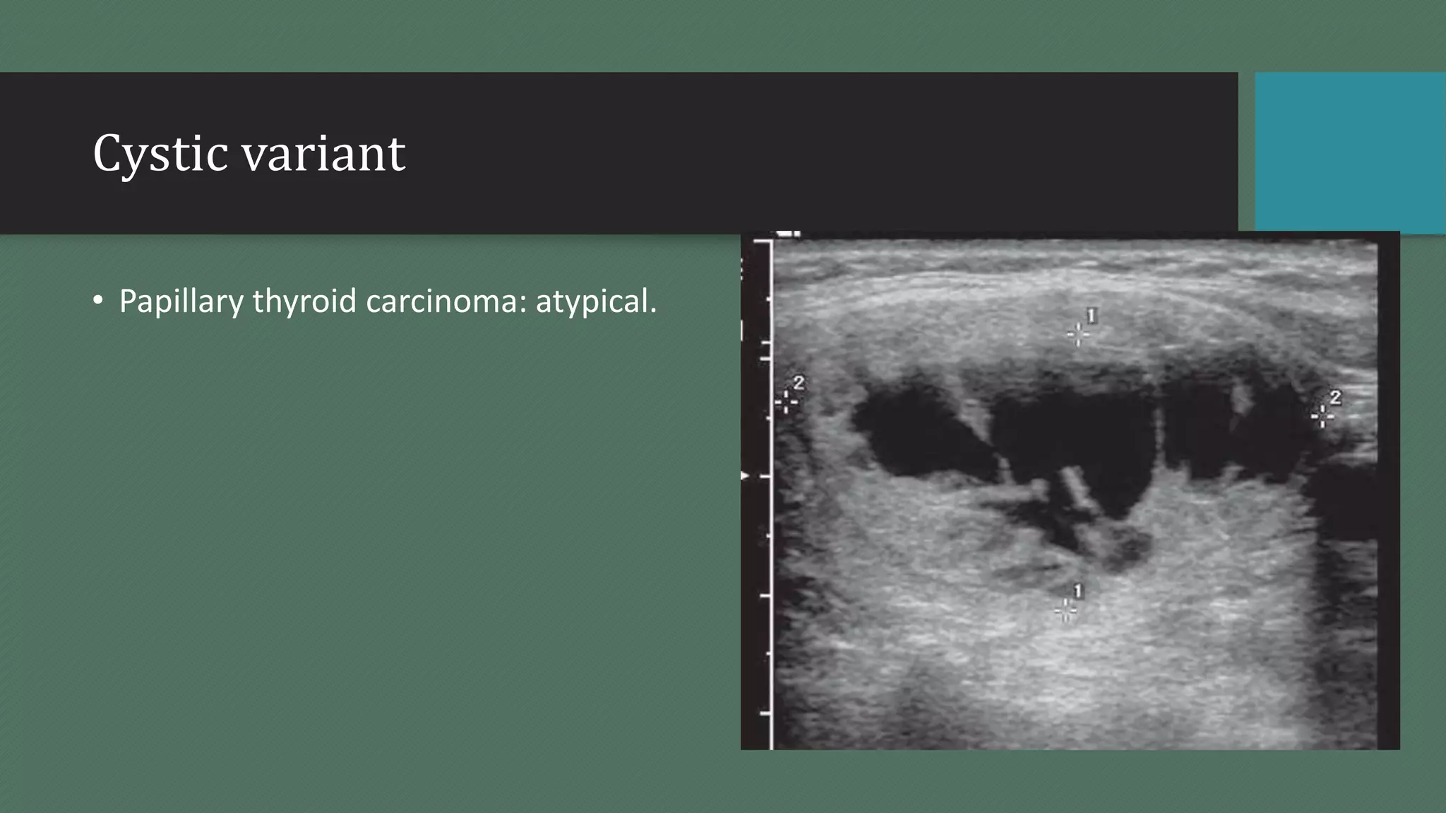 Imaging of thyroid | PPTX