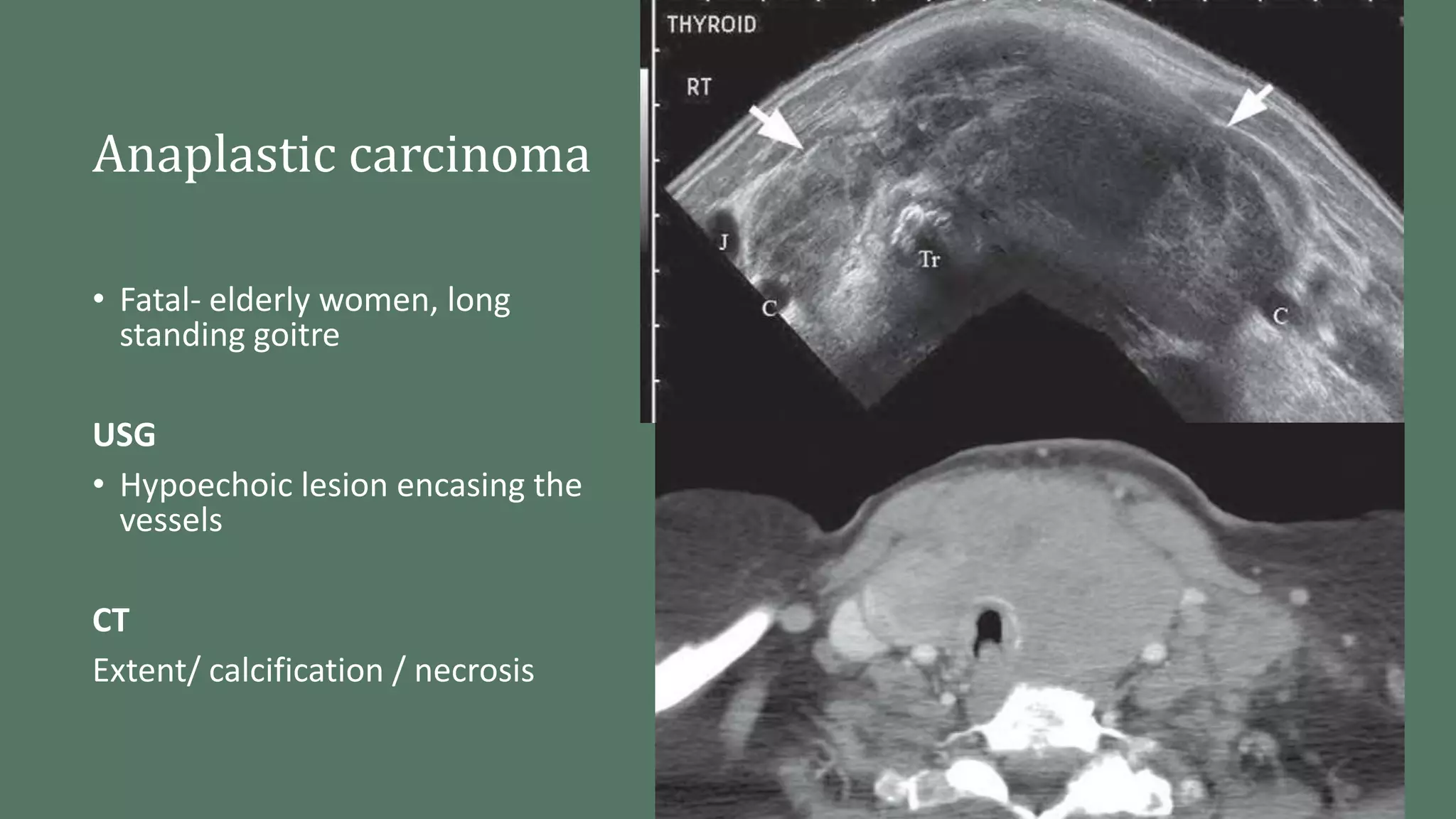 Imaging of thyroid | PPTX