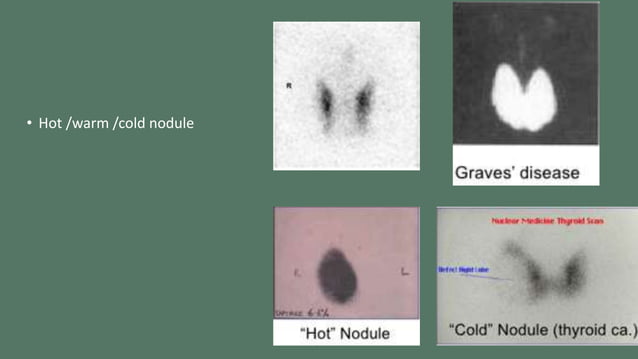 Imaging of thyroid | PPTX | Thyroid Disorders | Endocrine and Metabolic ...