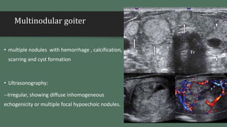 Multinodular Goiter Ultrasound