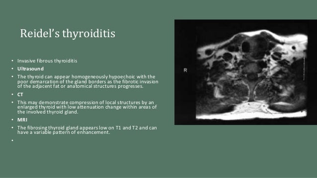 Imaging of thyroid