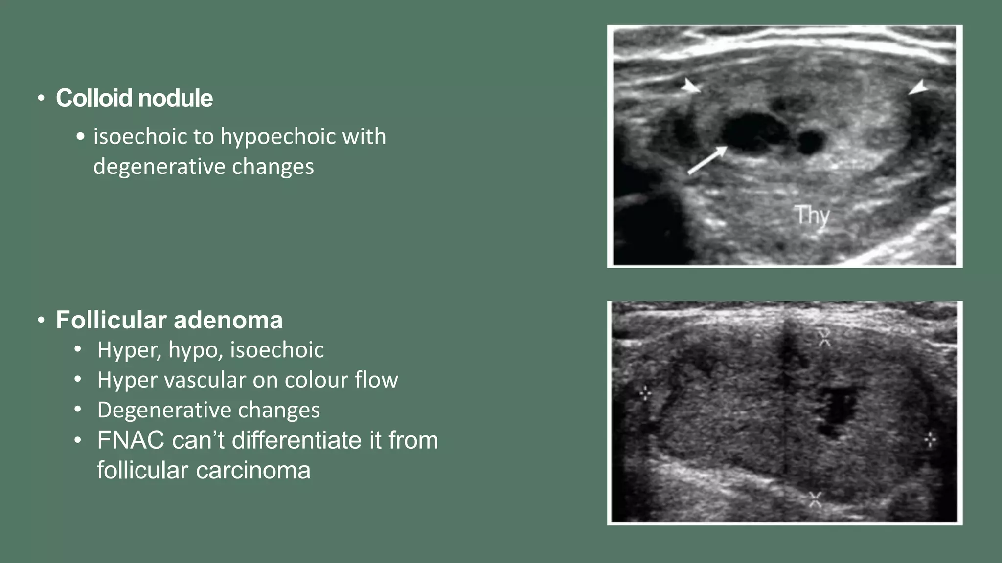 Imaging Of Thyroid Lesions Pptx Thyroid Disorders Endocrine And Metabolic Diseases