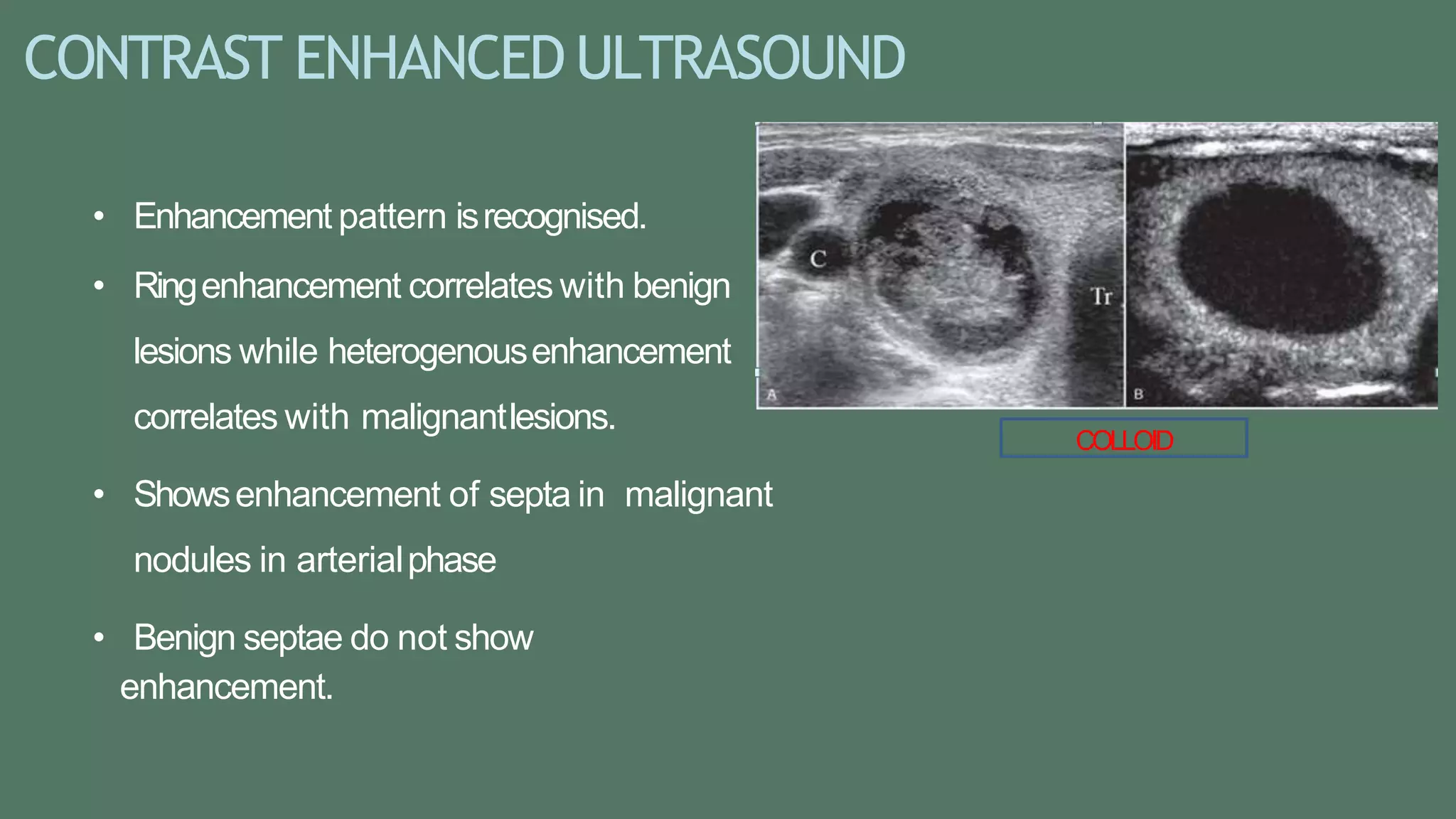 Imaging Of Thyroid Lesions Pptx Thyroid Disorders Endocrine And Metabolic Diseases