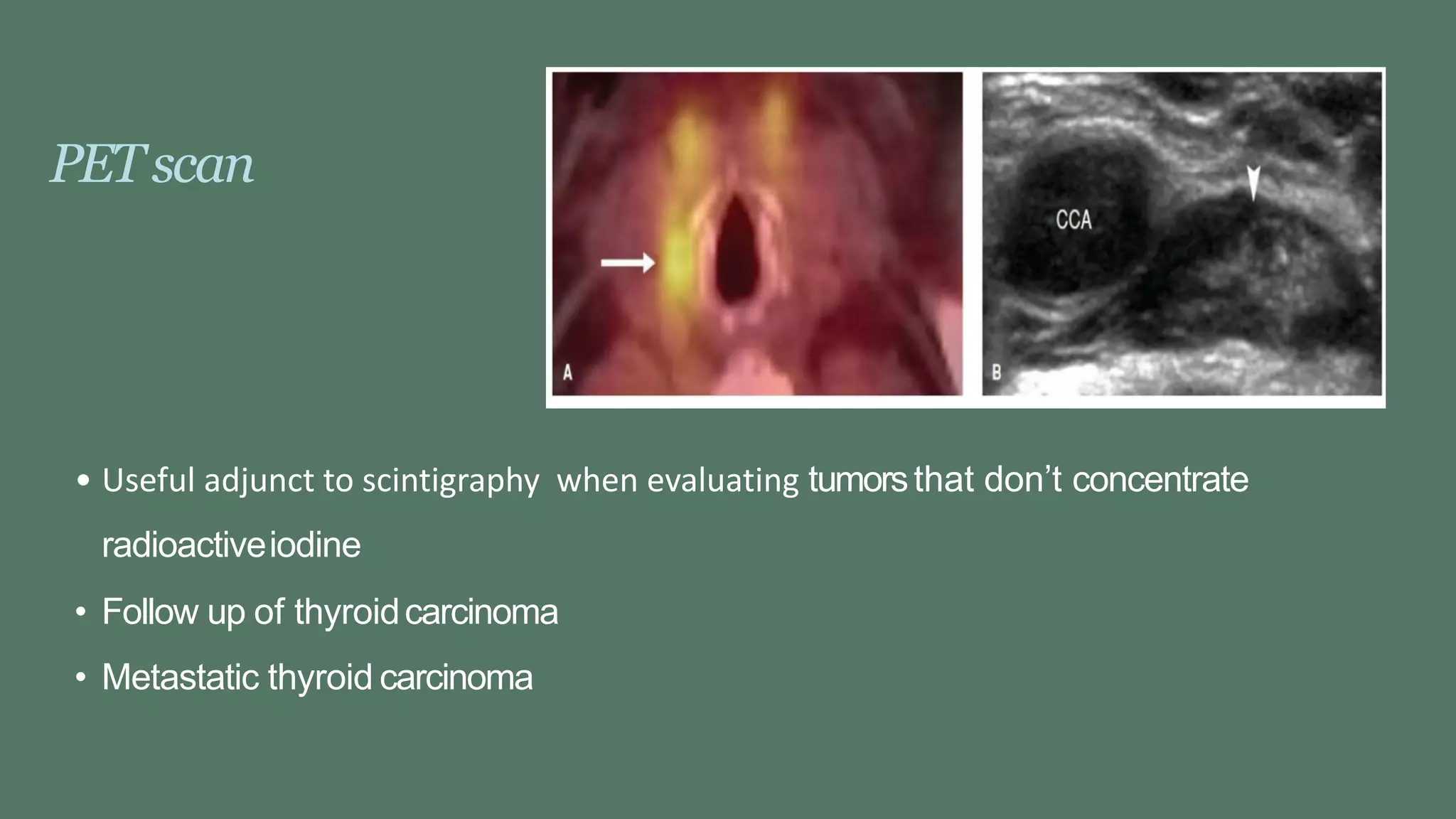Imaging Of Thyroid Lesions Pptx Thyroid Disorders Endocrine And Metabolic Diseases