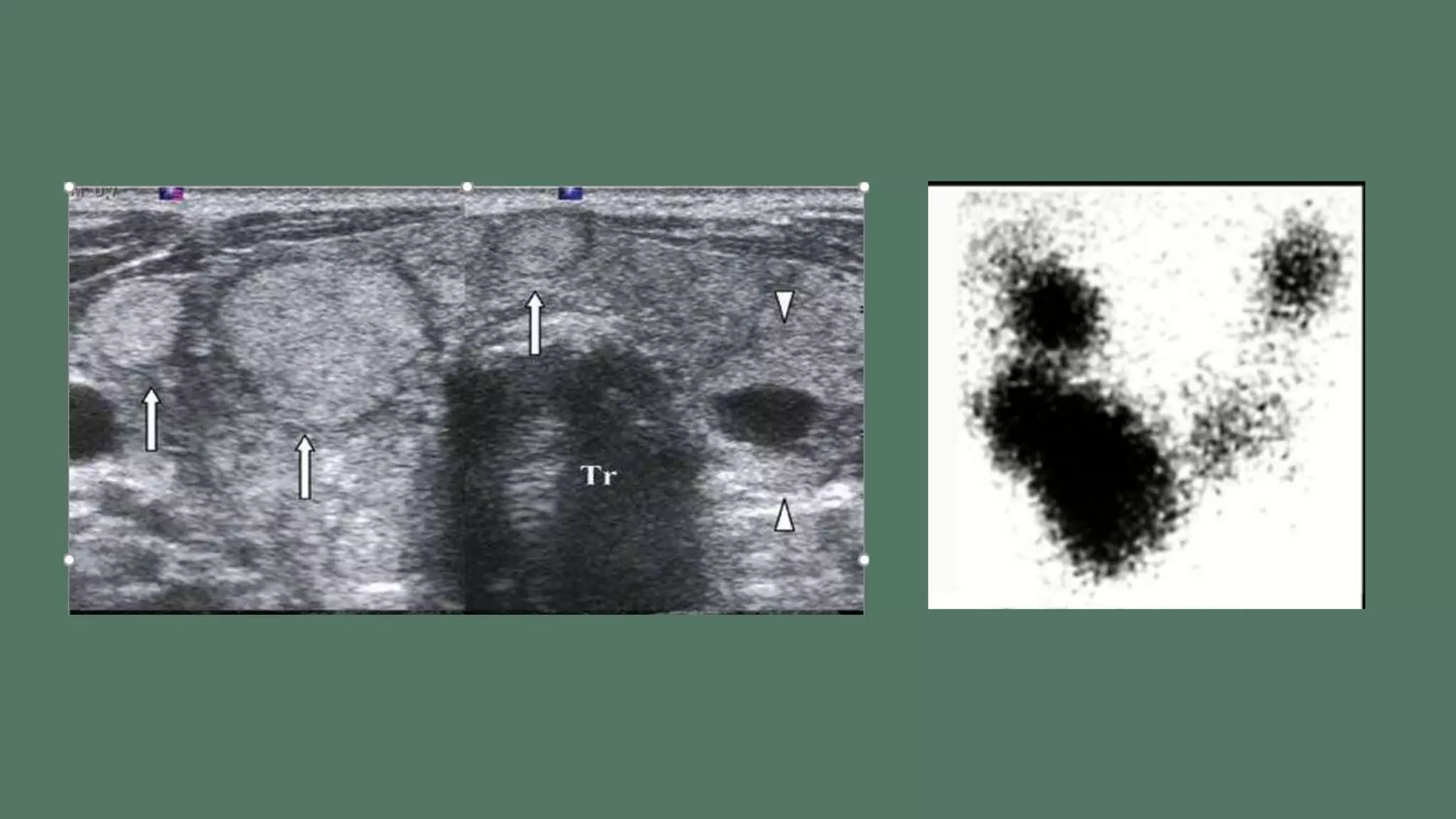 Imaging Of Thyroid Lesions Pptx Thyroid Disorders Endocrine And Metabolic Diseases