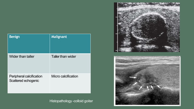 Imaging Of Thyroid Lesions Pptx Thyroid Disorders Endocrine And Metabolic Diseases