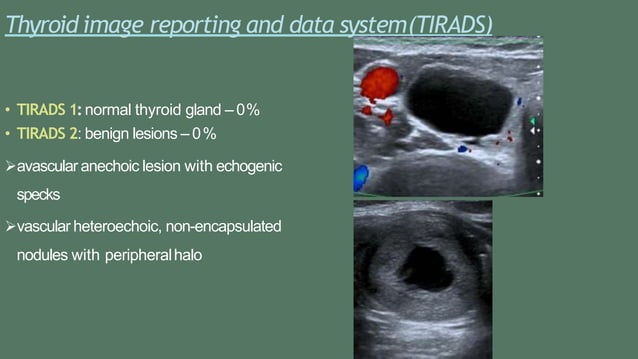 Imaging Of Thyroid Lesions Pptx Thyroid Disorders Endocrine And Metabolic Diseases