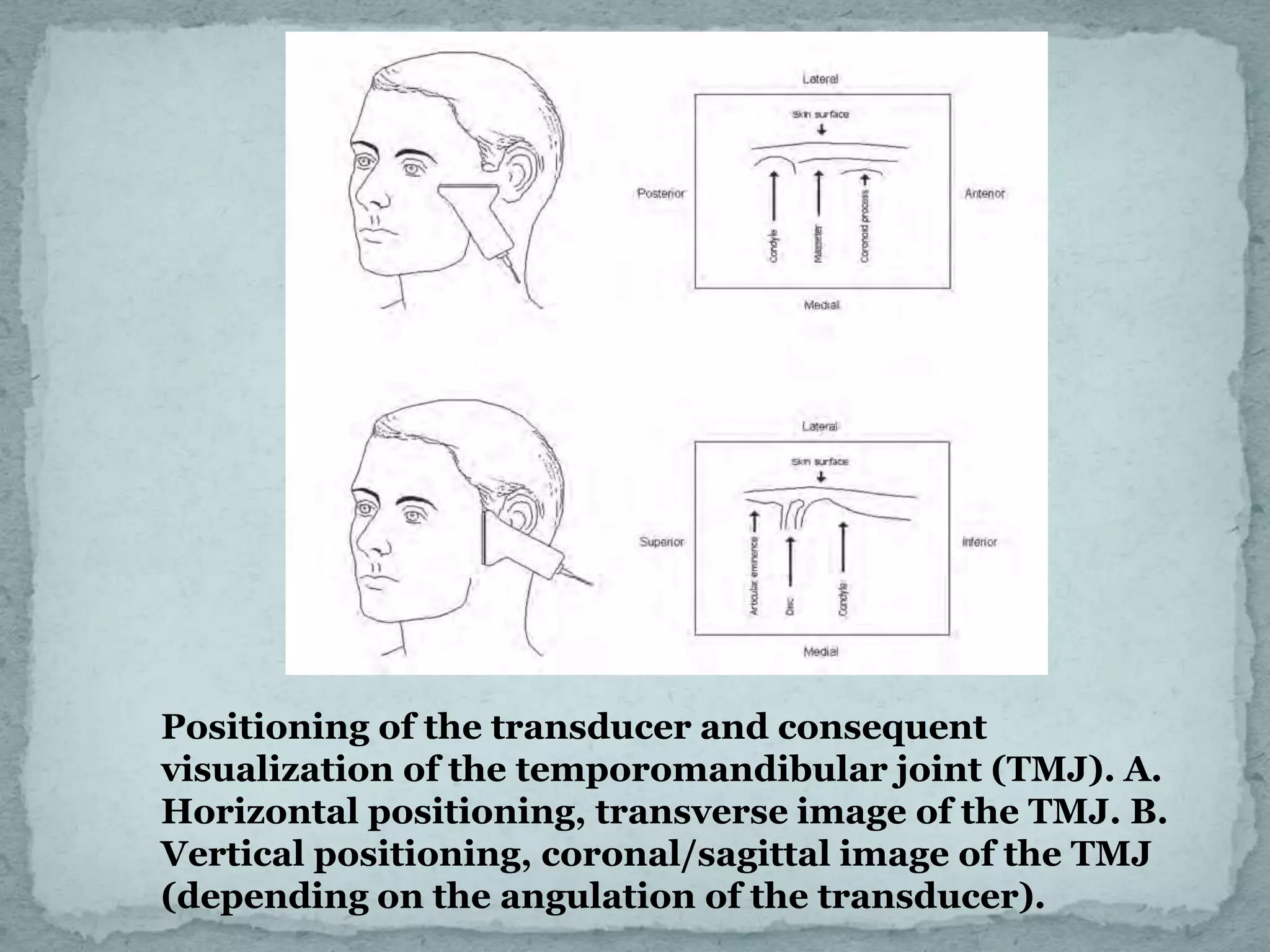 Imaging of TMJ | PPTX | Death, Injury, or Military Conflict | Sensitive ...