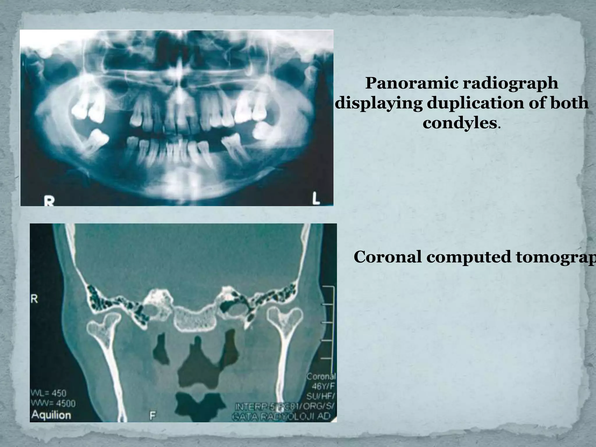 Imaging of TMJ | PPTX