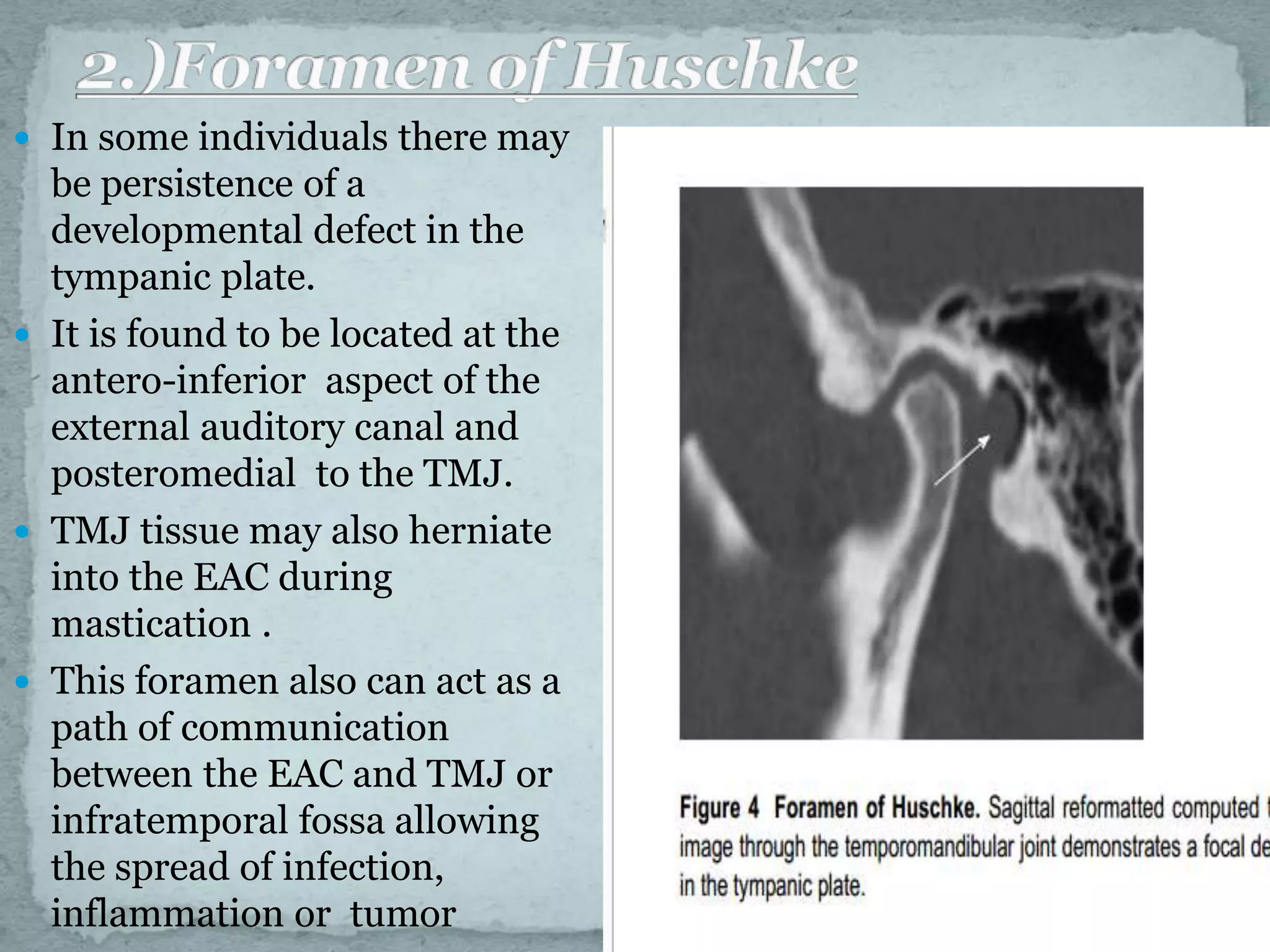 Imaging of TMJ | PPTX | Death, Injury, or Military Conflict | Sensitive ...
