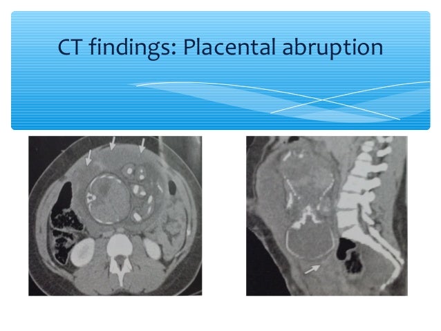 Imaging of trauma in pregnant patient
