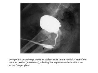 Imaging of urethral pathologies | PPT